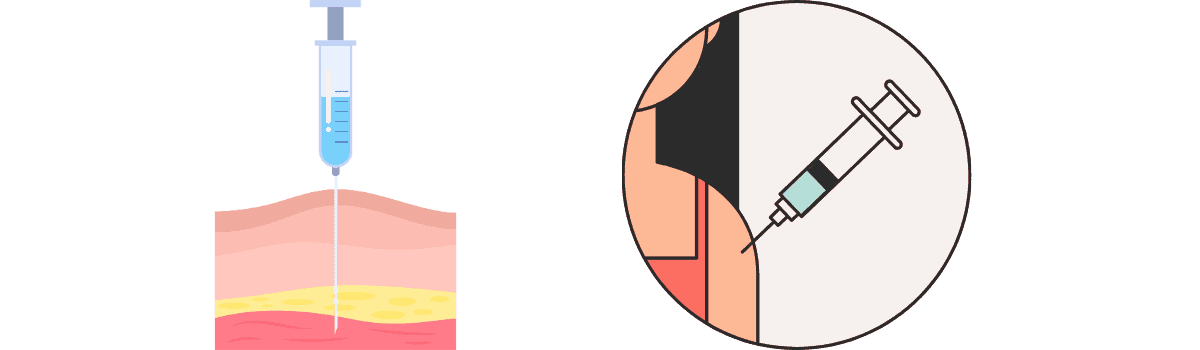Injections sous-cutanée et Intramusculaire - Ide Fiches