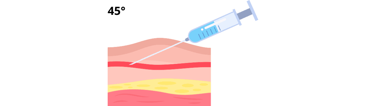 Injections sous-cutanée et Intramusculaire - Ide Fiches